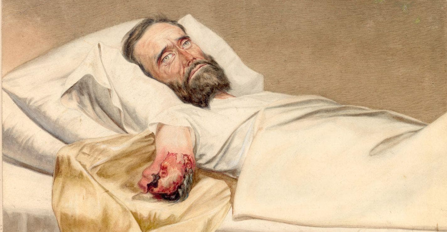 What It's Like to Have a Limb Amputated