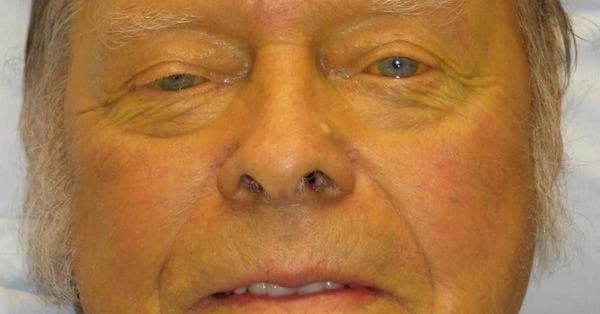 Wilson's Disease Symptoms | List of Signs of Wilson's Disease