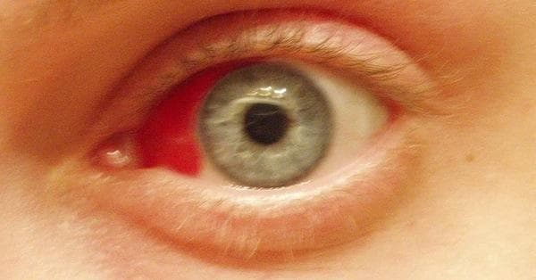 Iritis Symptoms | List of Signs of Iritis