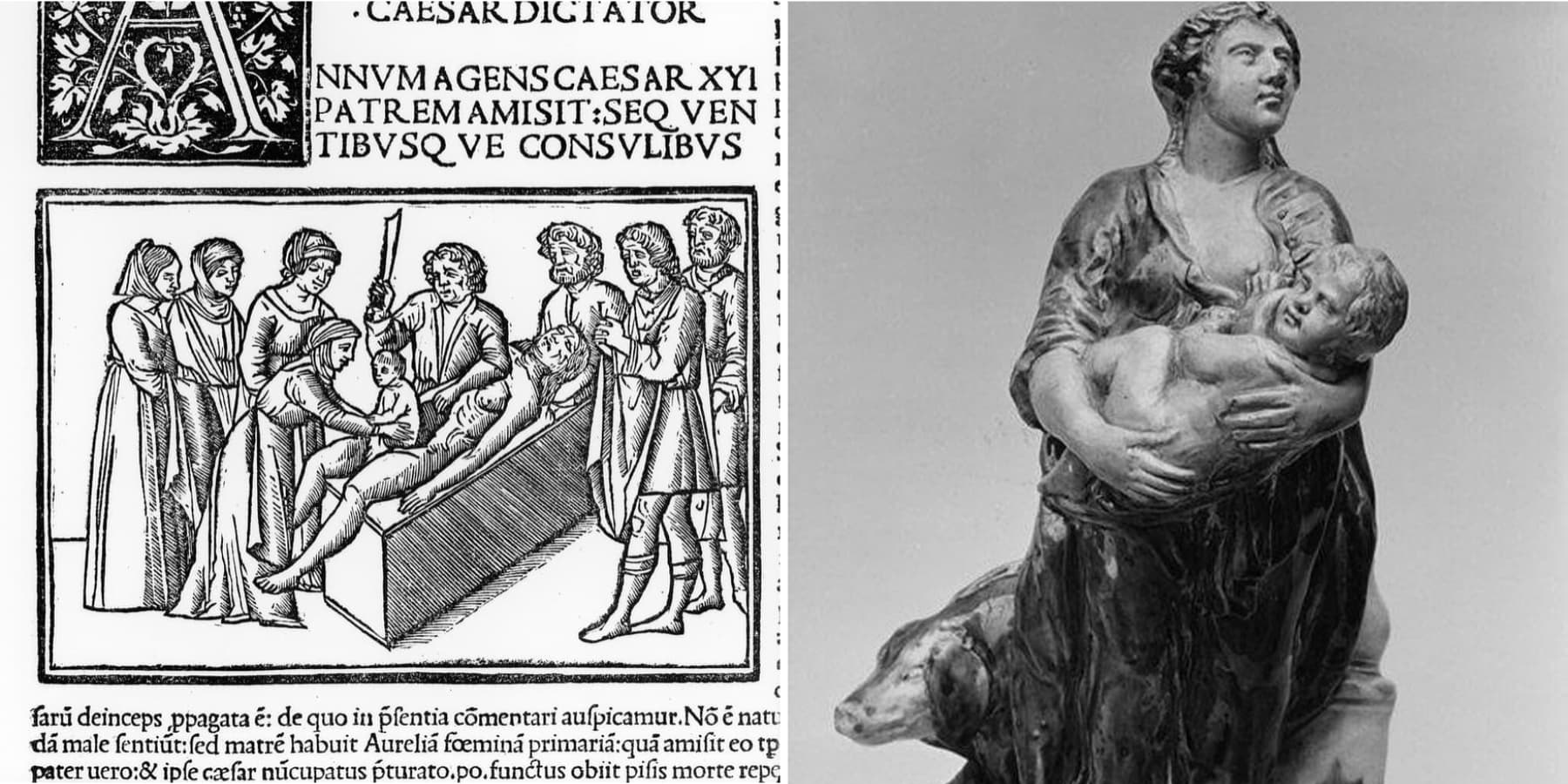 A History Of C-Section Surgeries