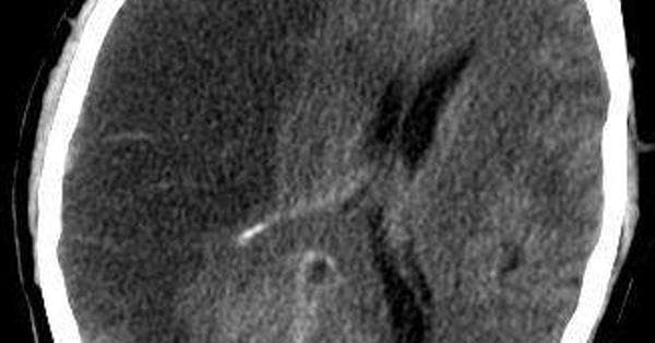 What Causes Quadriplegia | Diseases Associated with Quadriplegia