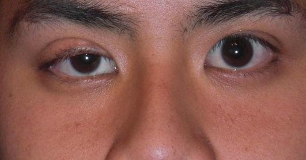 Noonan Syndrome Symptoms | List of Signs of Noonan Syndrome