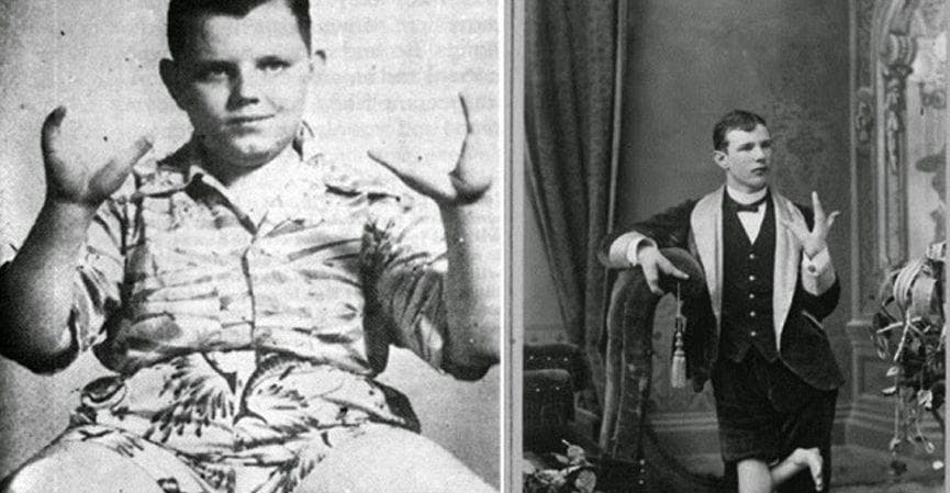 Meet Grady Stiles, The Murderous Lobster Boy Who Killed His Daughter's ...