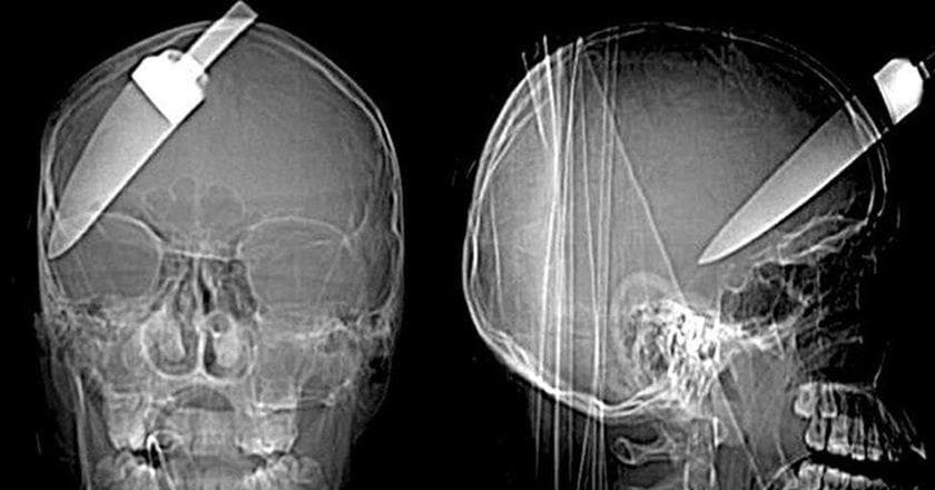 25 Brutal X-Ray Pictures That Will Make Your Bones Hurt