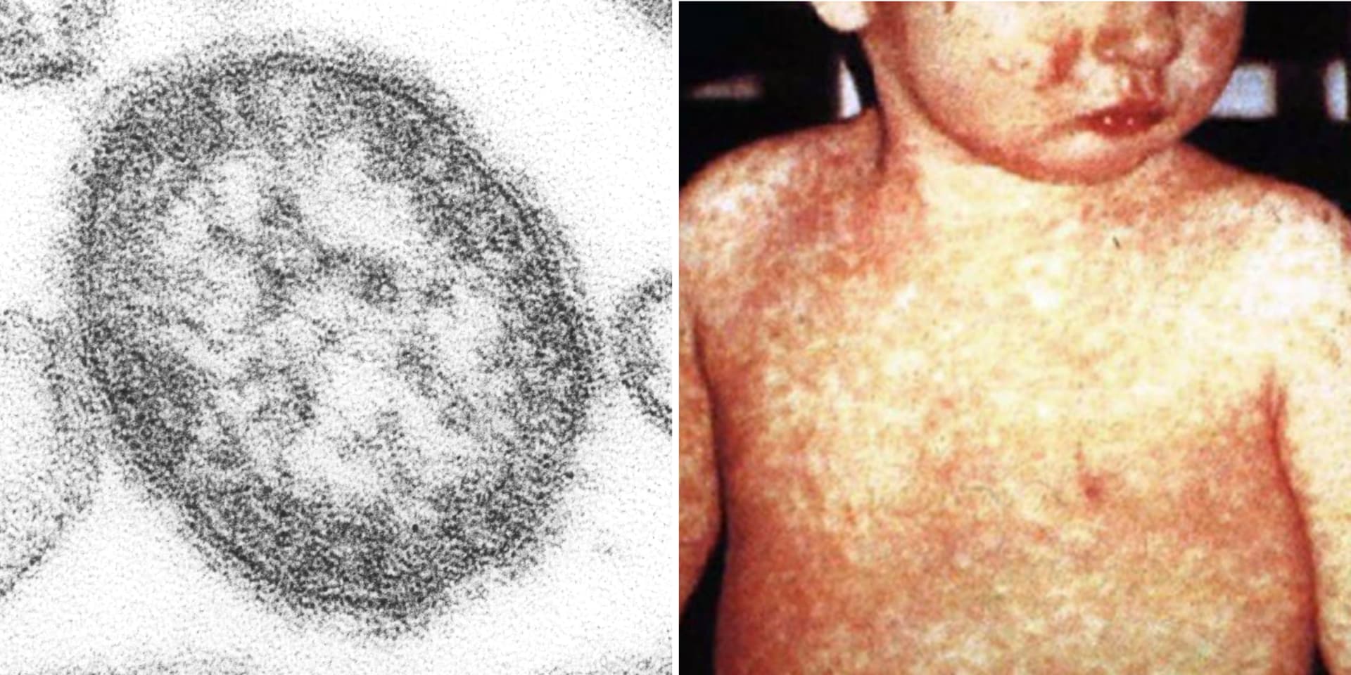 Here's What Measles Actually Does To Your Body