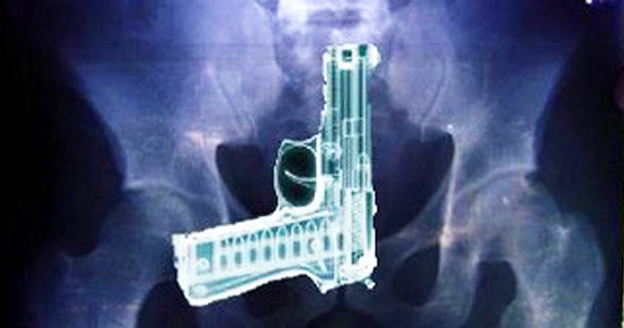 The 14 Craziest Objects Ever Found Inside People