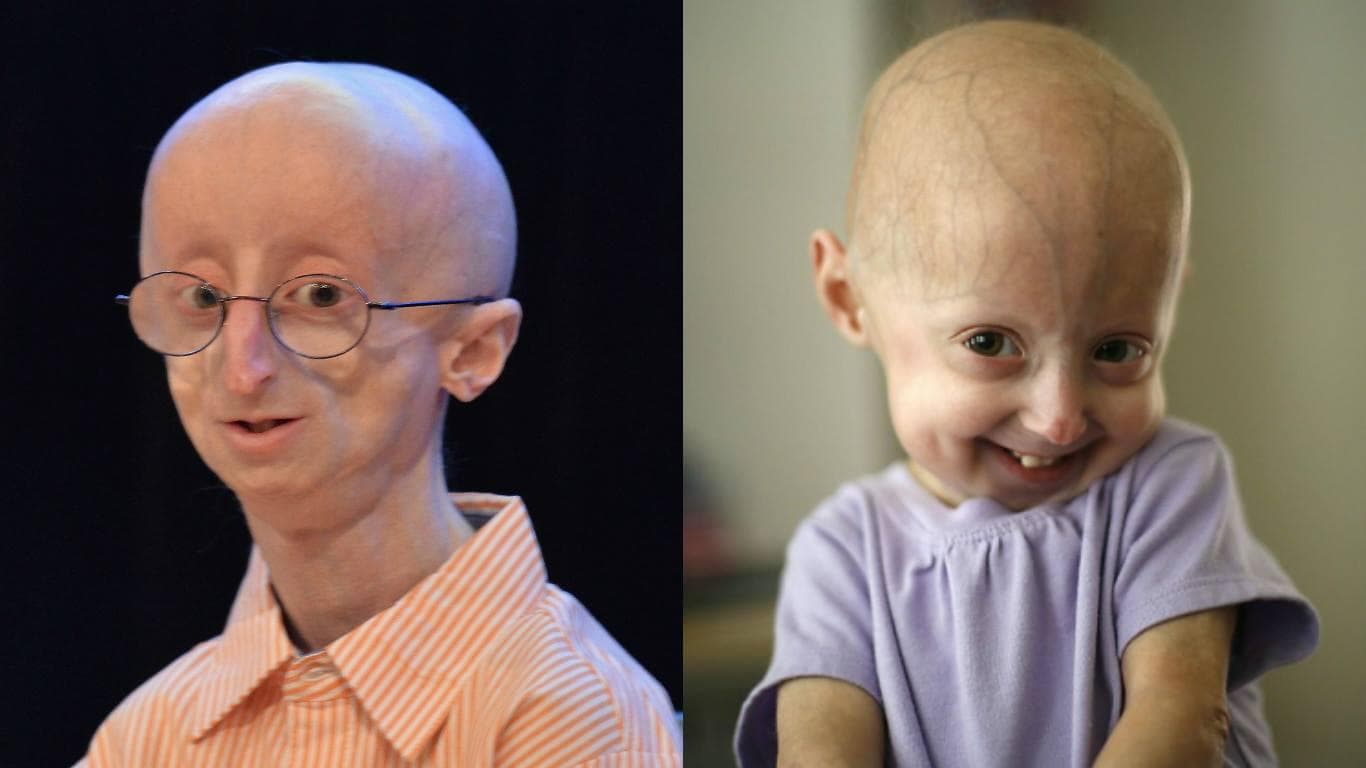 15 Fascinating Facts About Progeria, The Rapid Aging Disease