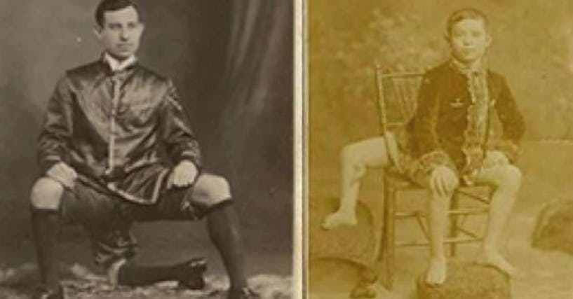 The Strange Life Of Frank Lentini, "The Three-Legged Wonder"