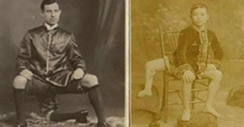The Strange Life Of Frank Lentini, "The Three-Legged Wonder"