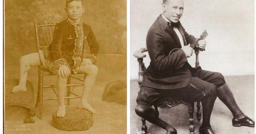 The Strange Life Of Frank Lentini, "The Three-Legged Wonder"