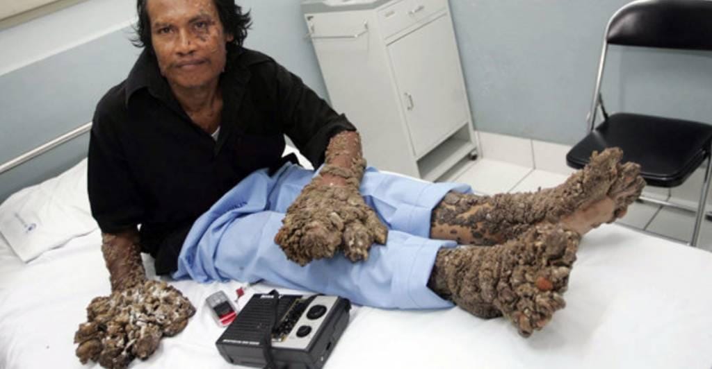 Tree Man Disease Is A Rare And Incurable Condition