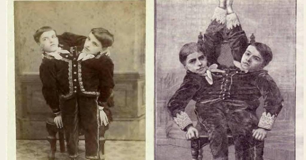 The Tocci Twins Exploited Their Own Rare Condition To Get Rich And ...