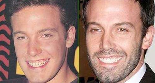 Celebrities with Fake Teeth | List of Famous People with Dentures and ...