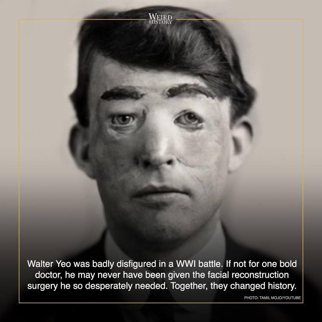 Walter Yeo Skin Graft