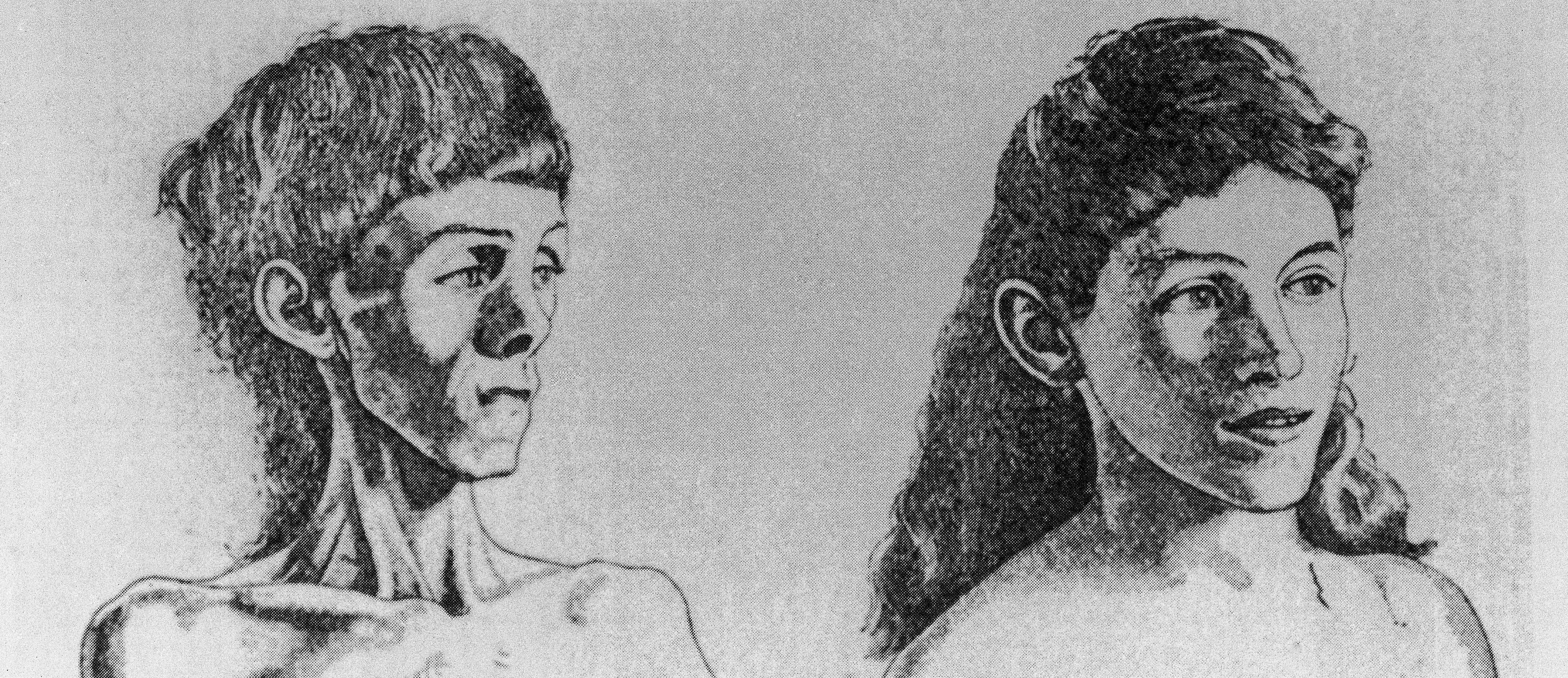Historical Diseases That Were Status Symbols