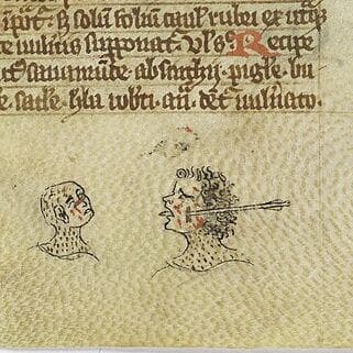 'The Extractor' Was A Painful Miracle Of Medieval Medicine That Saved A ...