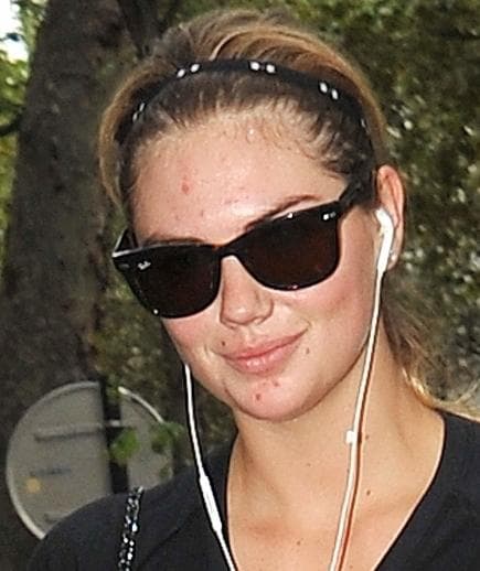 Celebrities With Acne | Famous People Who Had Acne When They Were Young