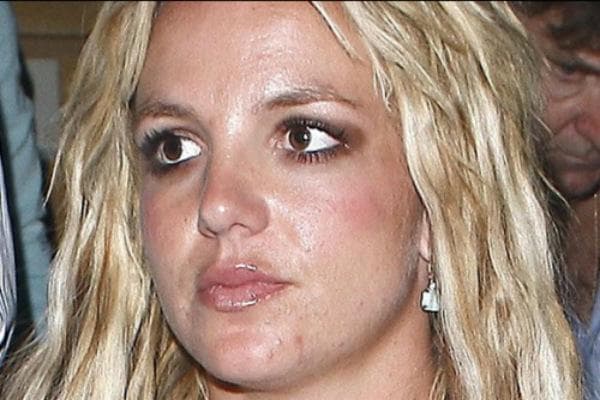 Britney Spears Acne Scars