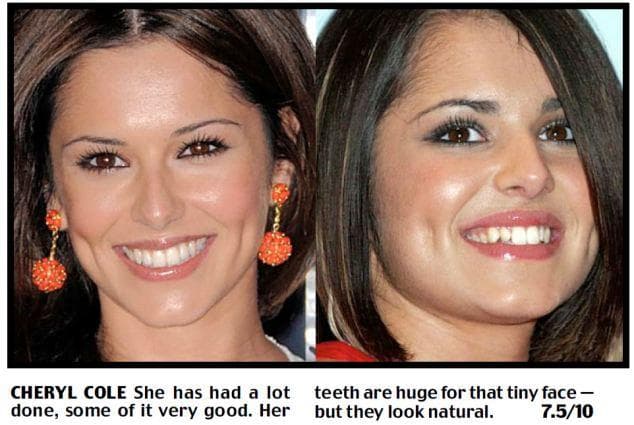Celebrities with Fake Teeth | List of Famous People with Dentures and ...