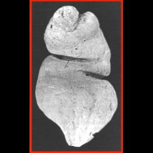 The 14 Craziest Objects Ever Found Inside People