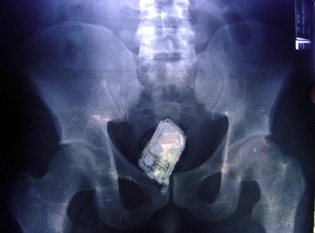 The 14 Craziest Objects Ever Found Inside People