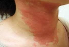 10 Telling Symptoms of Kidney Disease