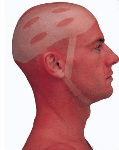 Worst Sunburn Photos | 54 Epic and Painful Sunburns