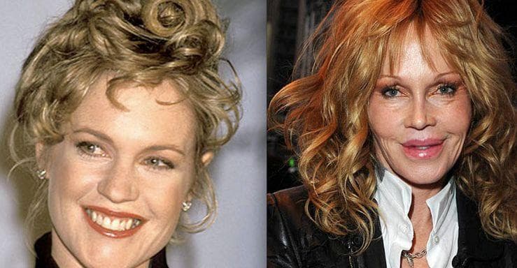 19 Lip Injections Gone Horribly Wrong