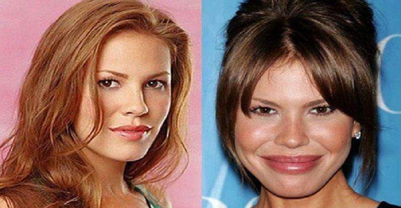 19 Lip Injections Gone Horribly Wrong