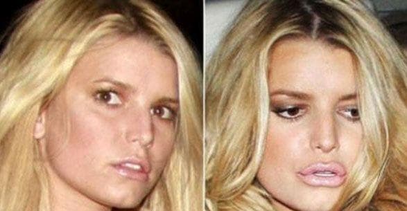 19 Freaky Cases of Lip Injections Gone Wrong