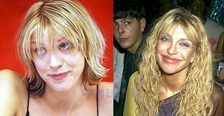 19 Freaky Cases of Lip Injections Gone Wrong