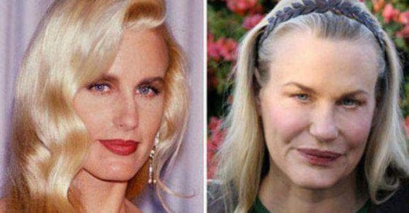 19 Freaky Cases of Lip Injections Gone Wrong