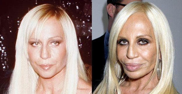 19 Freaky Cases of Lip Injections Gone Wrong