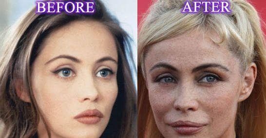 19 Freaky Cases of Lip Injections Gone Wrong