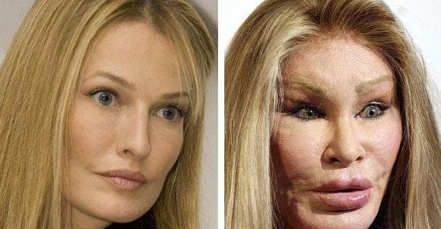 Botox On Lips Gone Bad | Lipstutorial.org