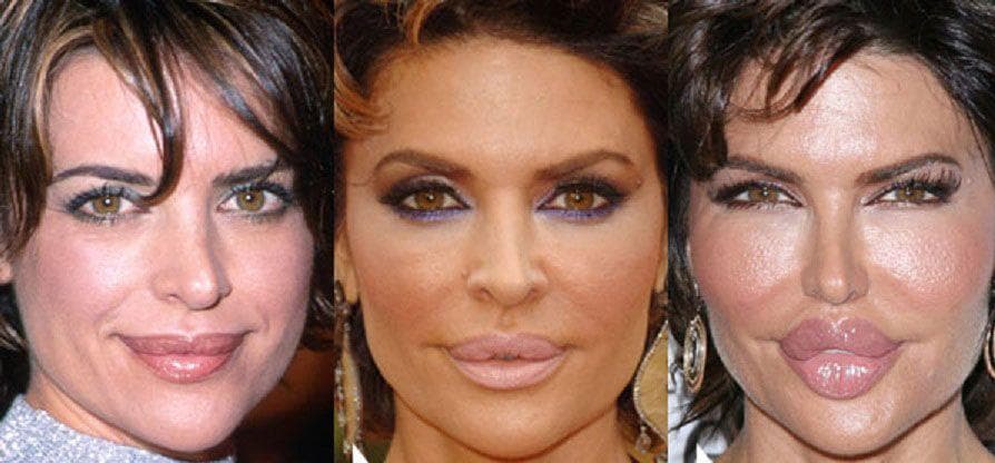 19 Freaky Cases of Lip Injections Gone Wrong