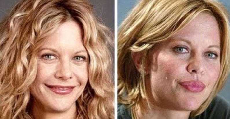 19 Freaky Cases of Lip Injections Gone Wrong