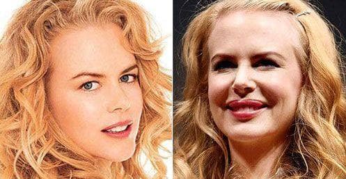 19 Freaky Cases of Lip Injections Gone Wrong