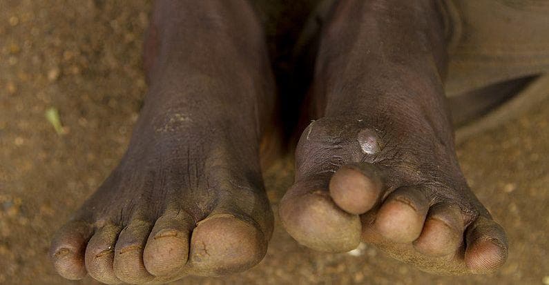 20 Scary Parasites You Can Get from Traveling
