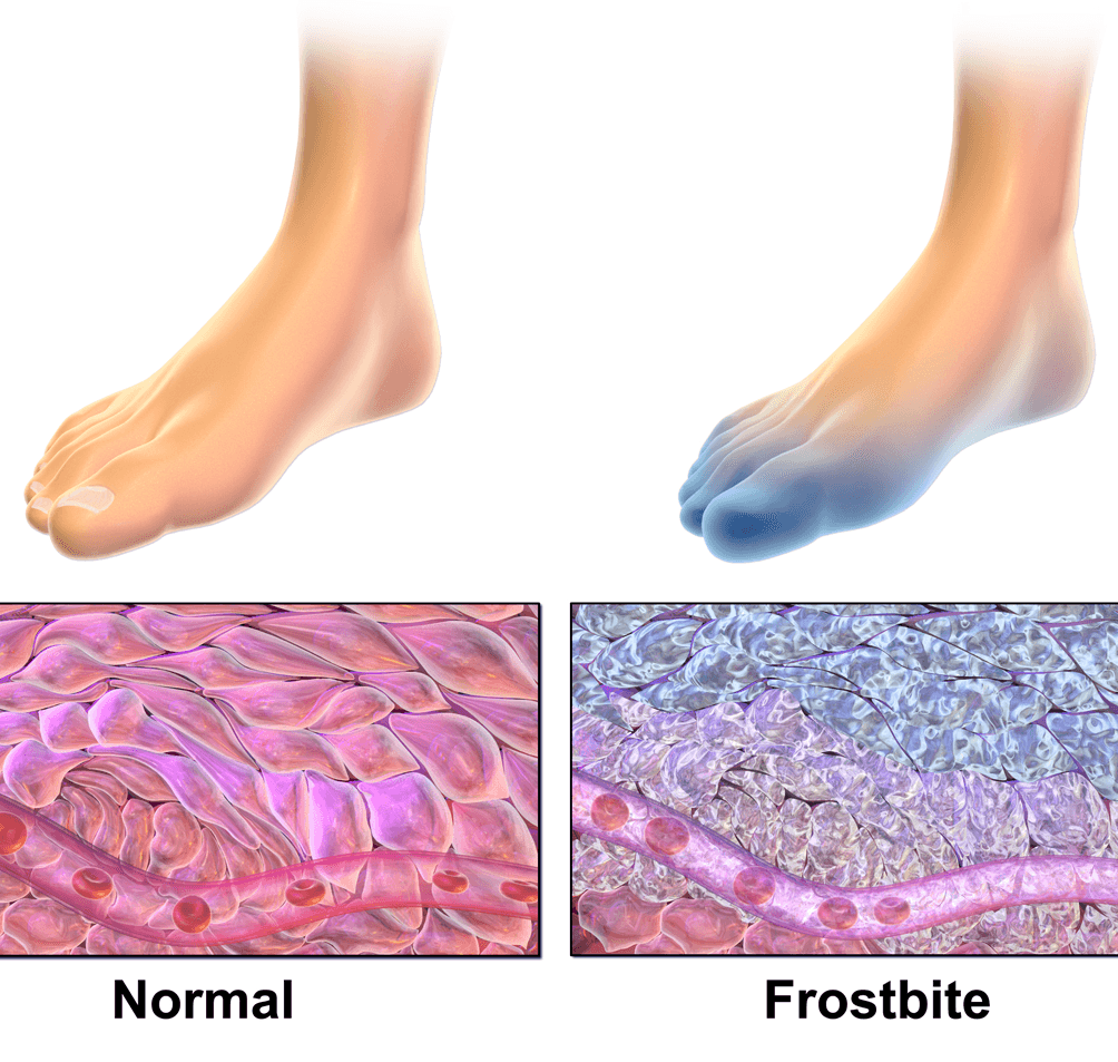 Freezing to Death: What Happens to Your Body