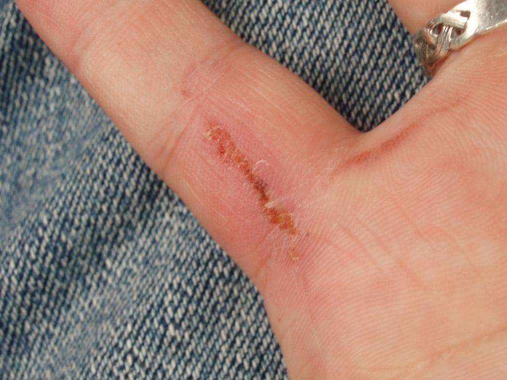 Things That Happen to You When You Have Flesh Eating Disease