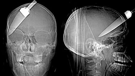 25-brutal-x-ray-pictures-that-will-make-your-bones-hurt