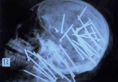 25 Brutal X-Ray Pictures That Will Make Your Bones Hurt