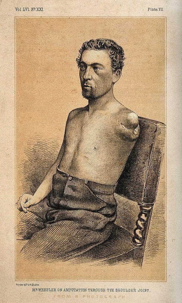 Phantom Limbs: What Happens to Your Body After Amputation