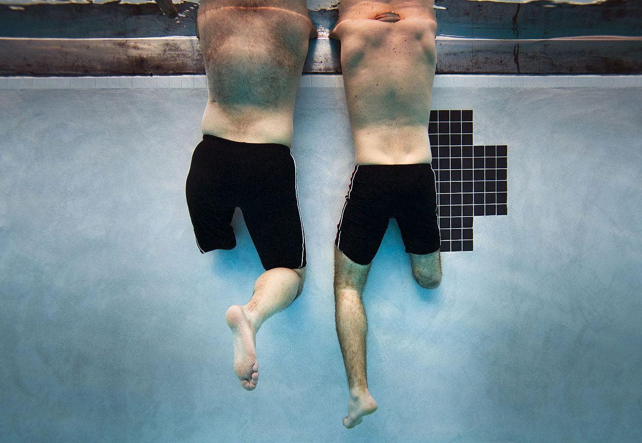 Phantom Limbs: What Happens to Your Body After Amputation