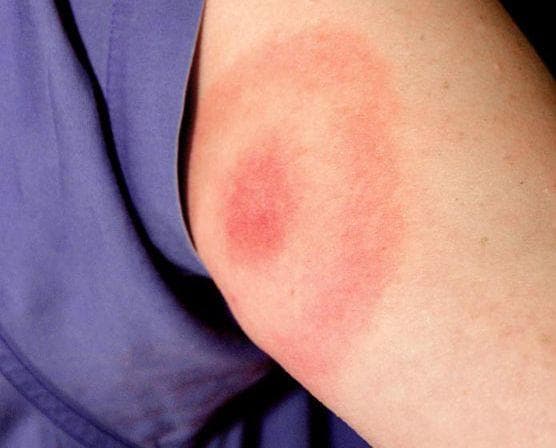 Everything That Happens to Your Body When You Get Lyme Disease