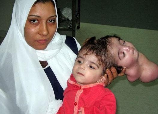 13 People Born With Mysterious Extra Body Parts