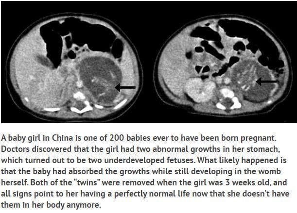 13 People Born With Mysterious Extra Body Parts