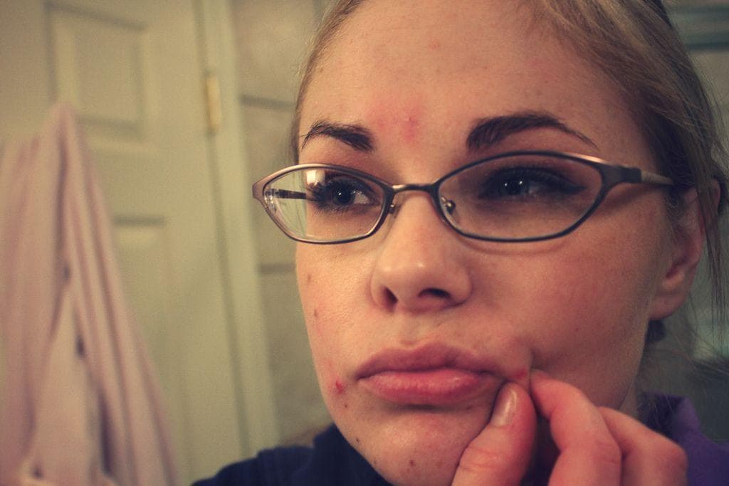 Horrifying Facts About Excoriation Disorder