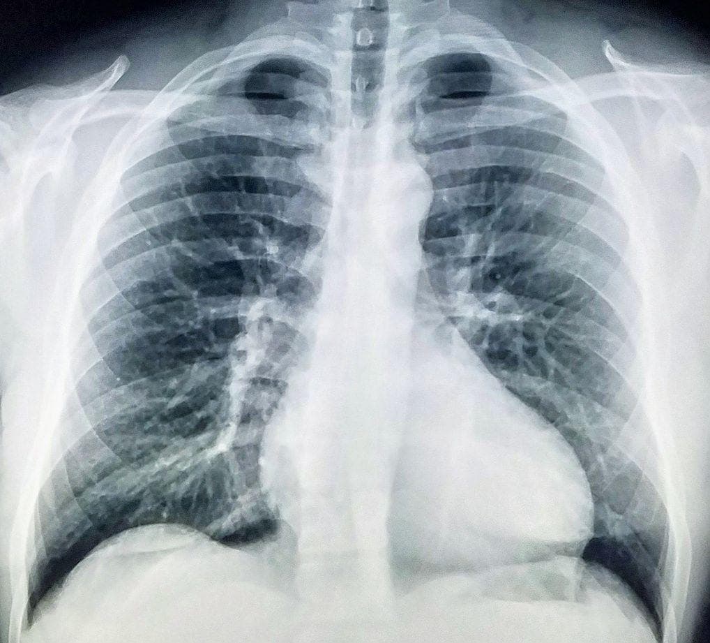 What Happens To Your Body When You Die In A Human Stampede